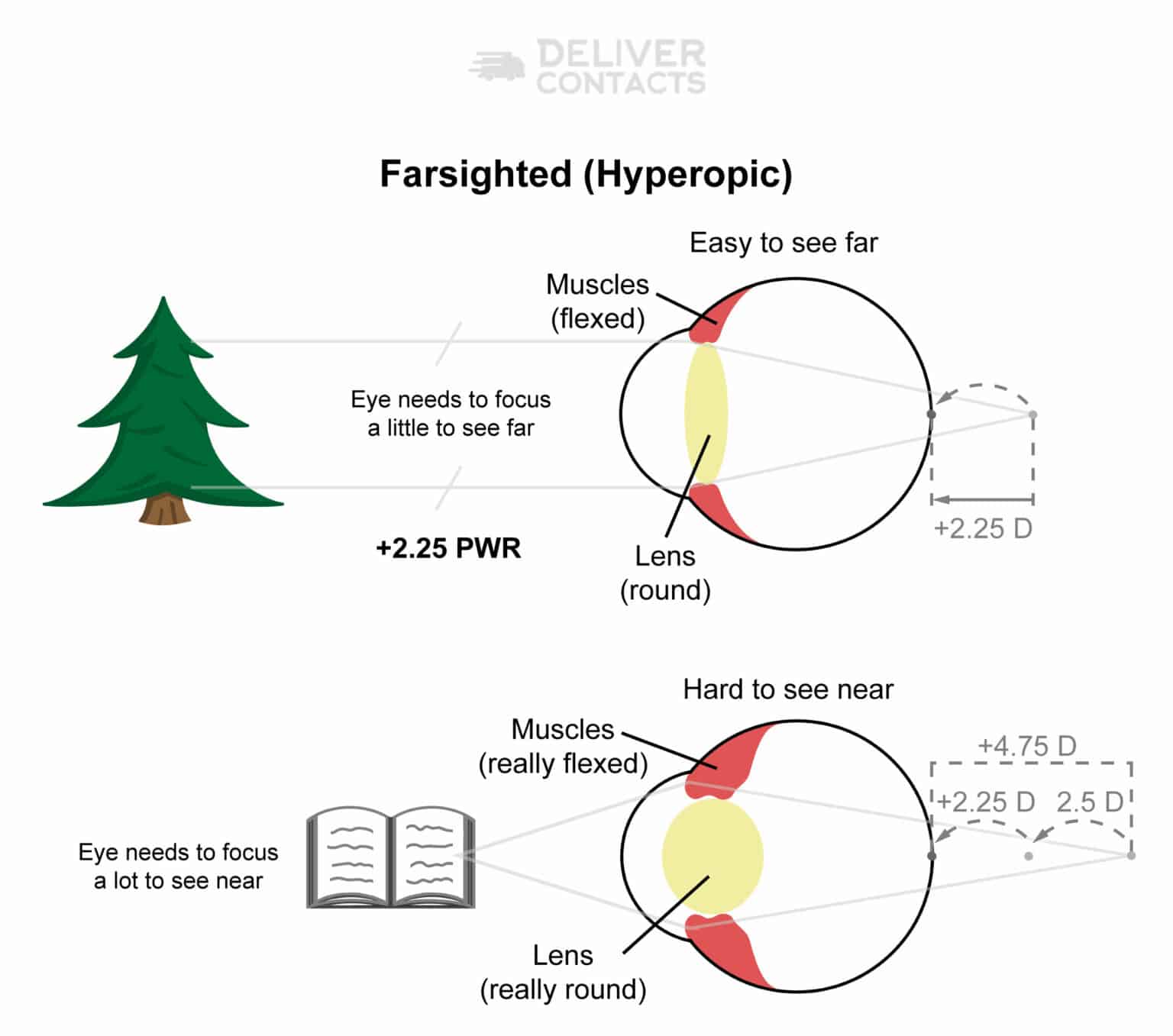 Hyperopia (Farsighted): Causes, Signs, & Treatment