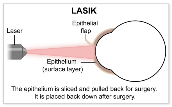 What Is LASIK Eye Surgery? | Deliver Contacts