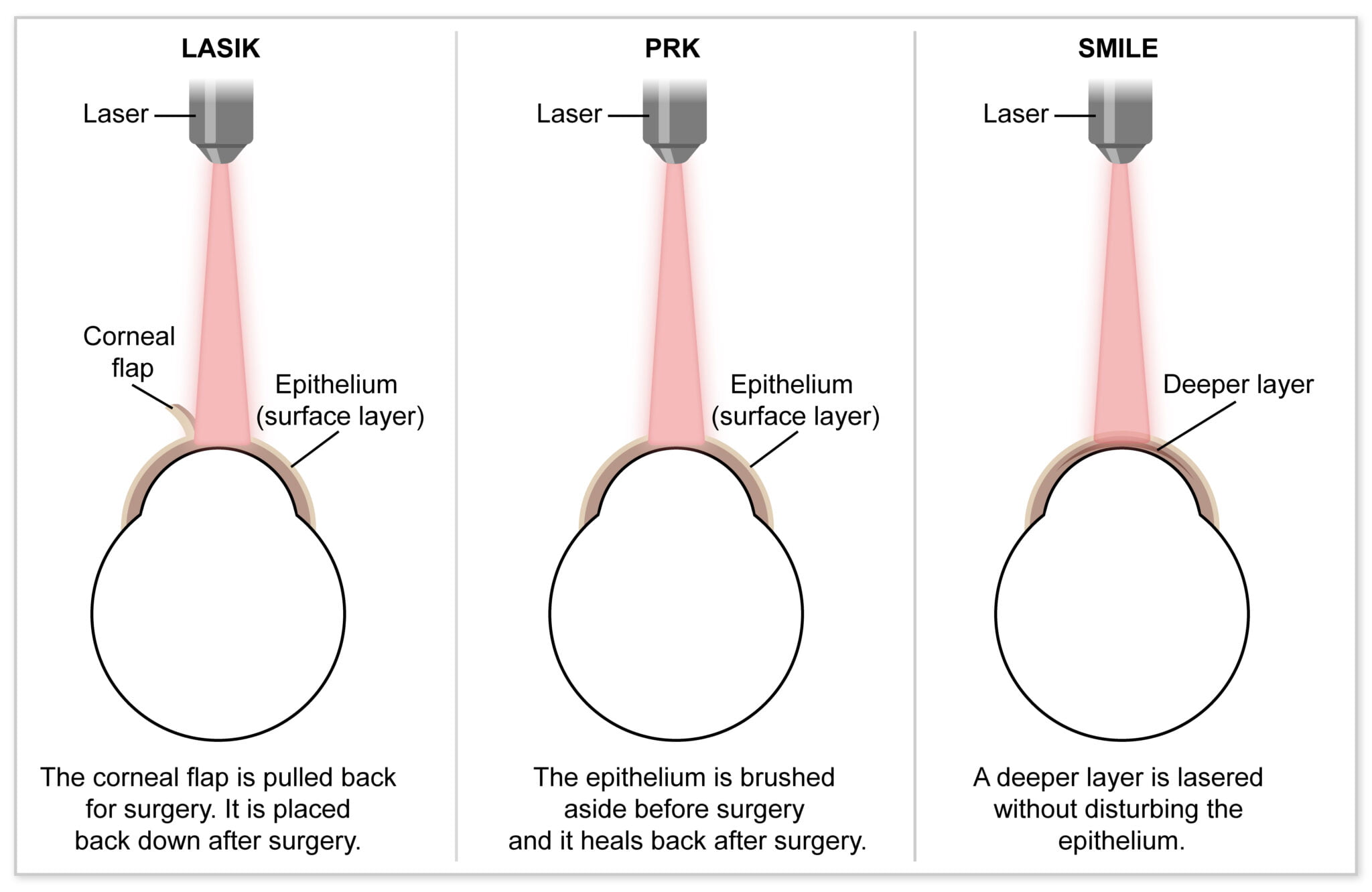 Types Of Laser Refractive Eye Surgery (LASIK, PRK, SMILE)